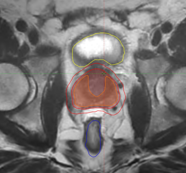 Treatment Planning | The SBRT Cure for Prostate Cancer